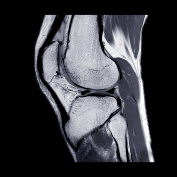 How to Use Open and Closed Chain Exercises in ACL Rehab | Pain Free ...