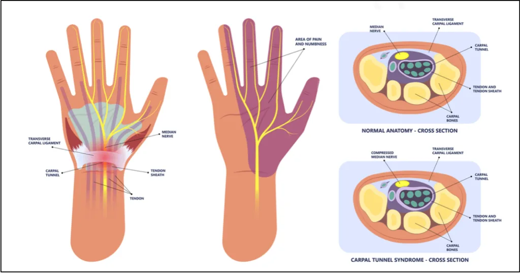 Carpal Tunnel Trigger Points