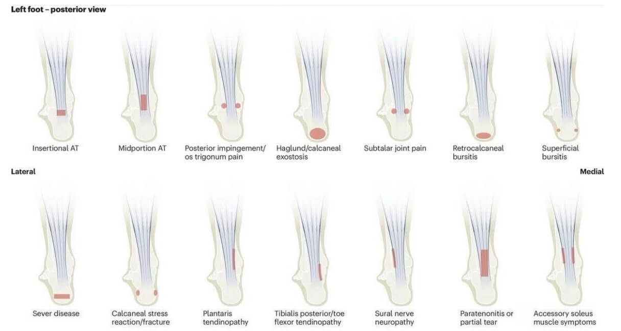 Understanding Different Types of Foot Pain and Where They Come From ...
